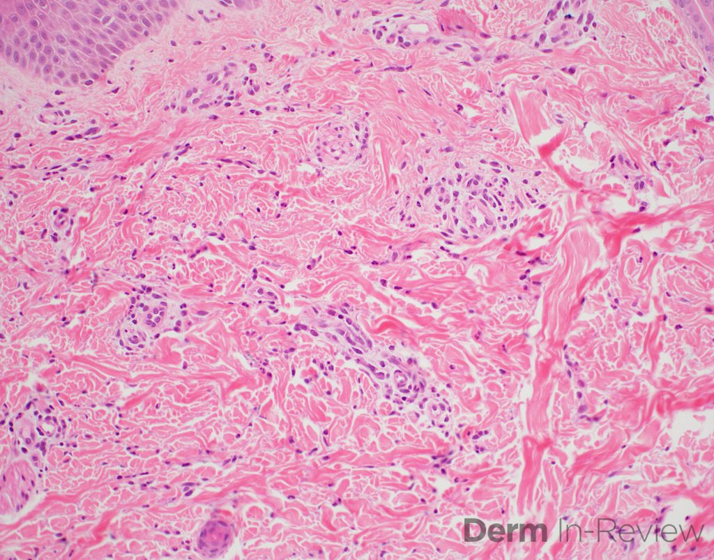 Figure 5.19.6 Neutrophilic and eosinophilic dermal infiltrates. – Derm ...