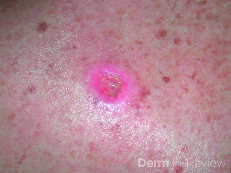 Figure 4.2.15 Superficial BCC – Derm In-Review
