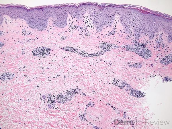 Figure 5.6.13 – Derm In-Review