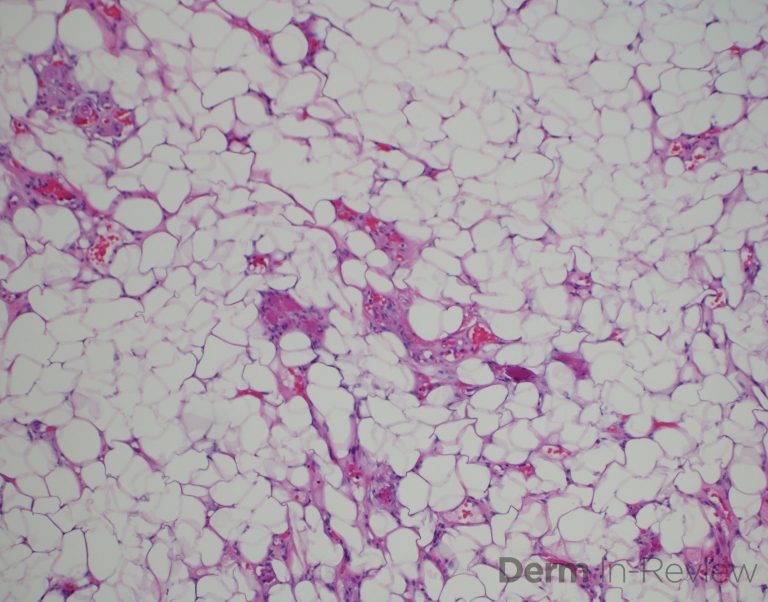 Figure 5.16.7 Lipomatous tumors. – Derm In-Review