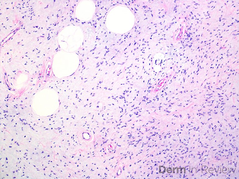 Figure 5.16.7 Lipomatous tumors. – Derm In-Review