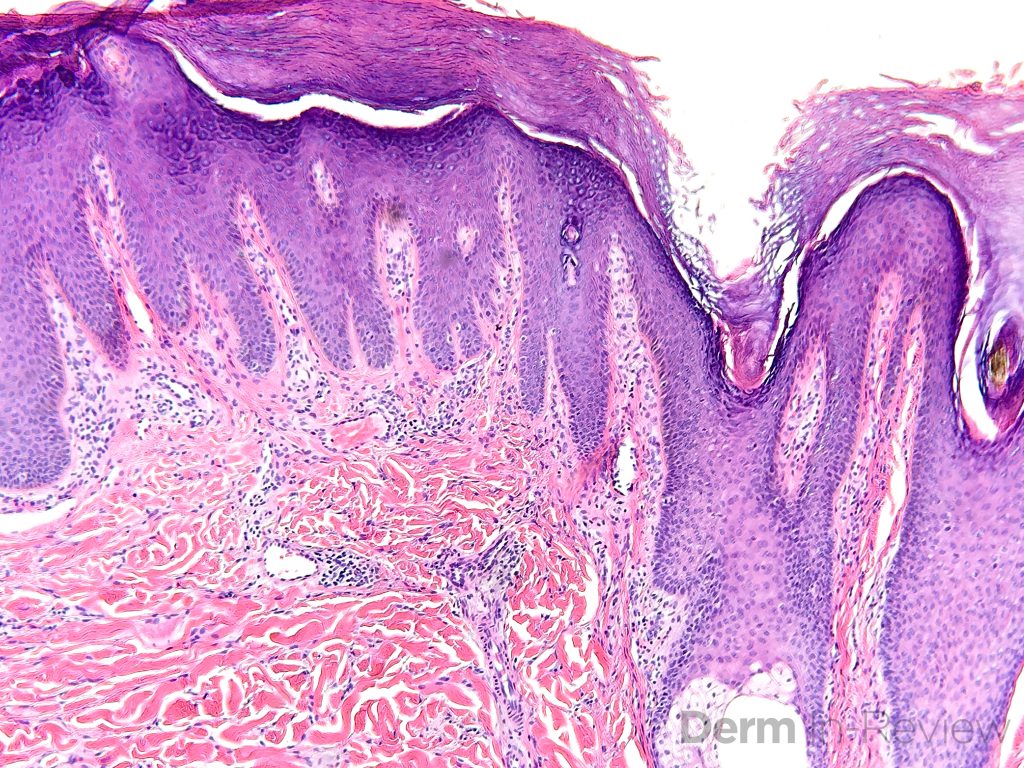 Figure 5.3.7 Spongiotic dermatitis. – Derm In-Review