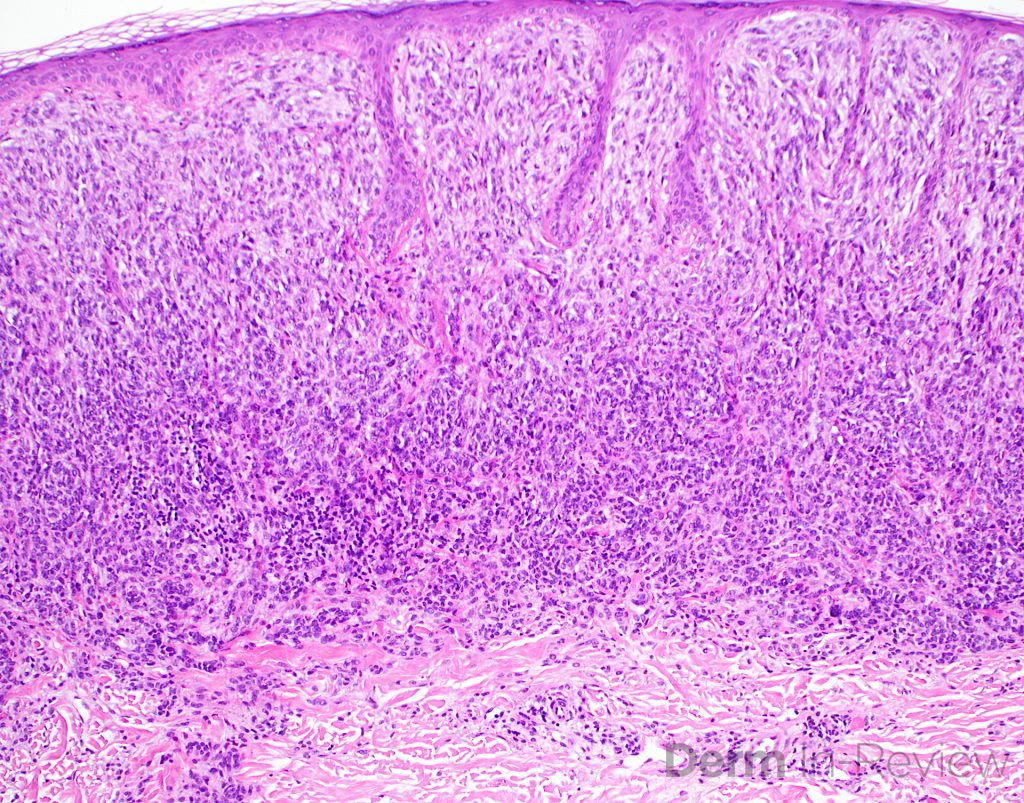 Figure 5.12.10 Comparison of conventional nevus, dysplastic nevus and ...
